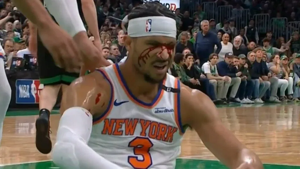 Josh Hart Bloodied After Taking Elbow to the Face from Luke Kornet - TMSPN