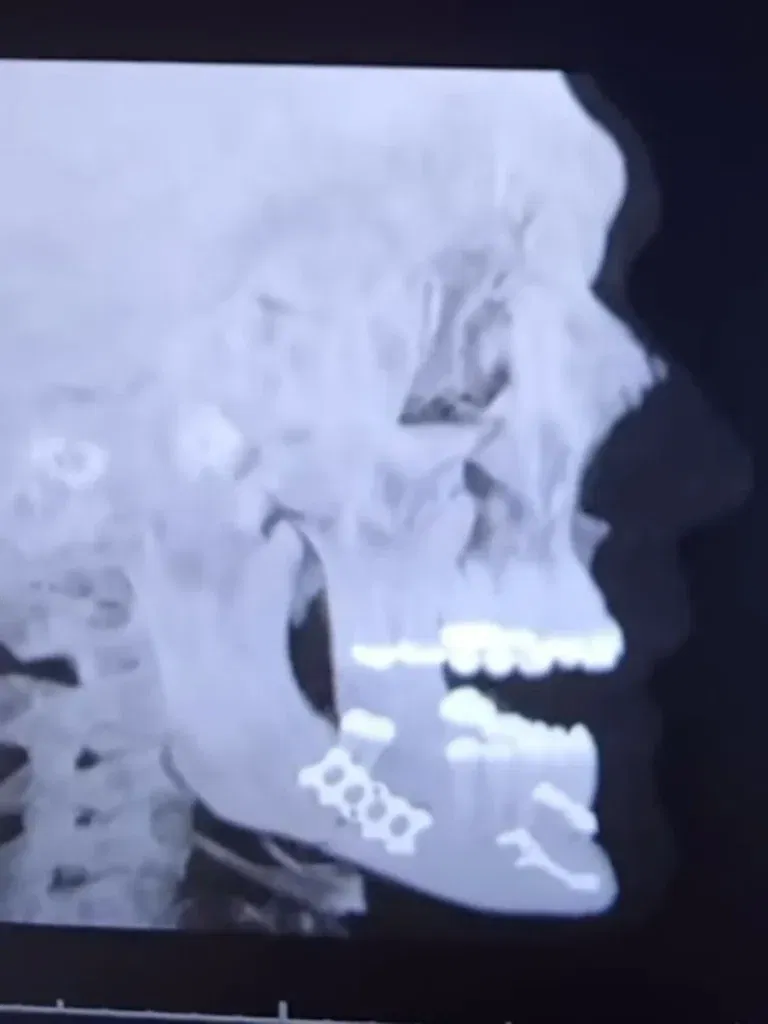 Jake Paul Reveals He Had Teeth Removed After Breaking His Jaw In ...